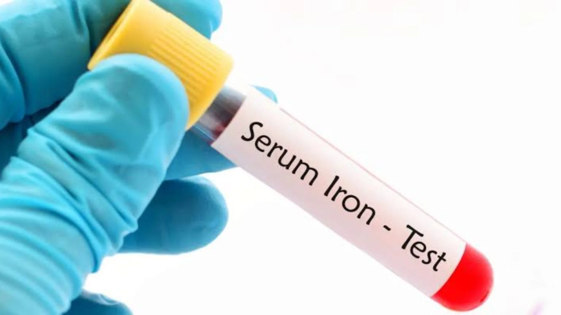 Serum Iron Test | Iron Levels & Anemia Screening 🔩