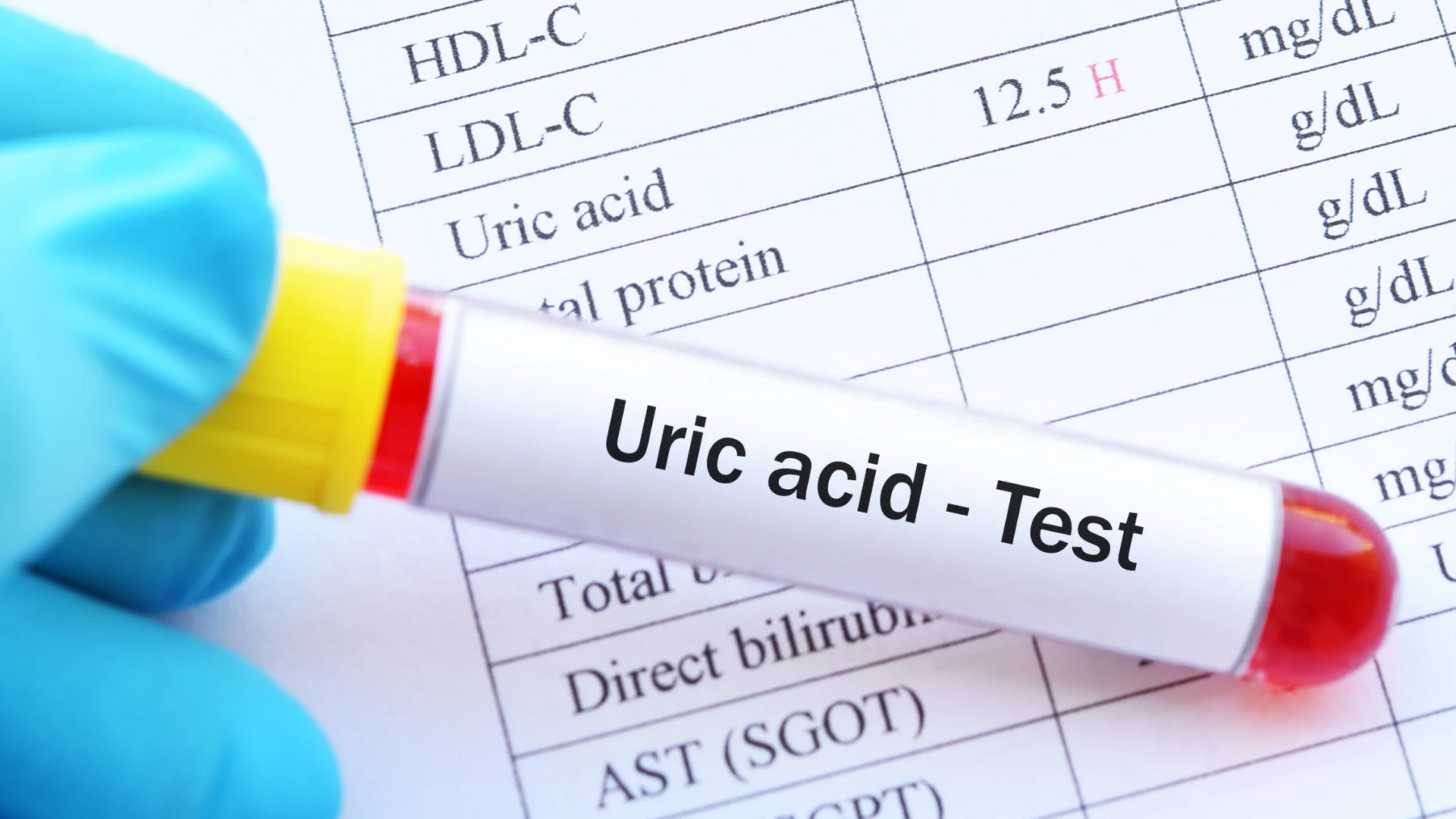 Uric Acid Test | Gout, Kidney Health & Metabolic Screening 💧