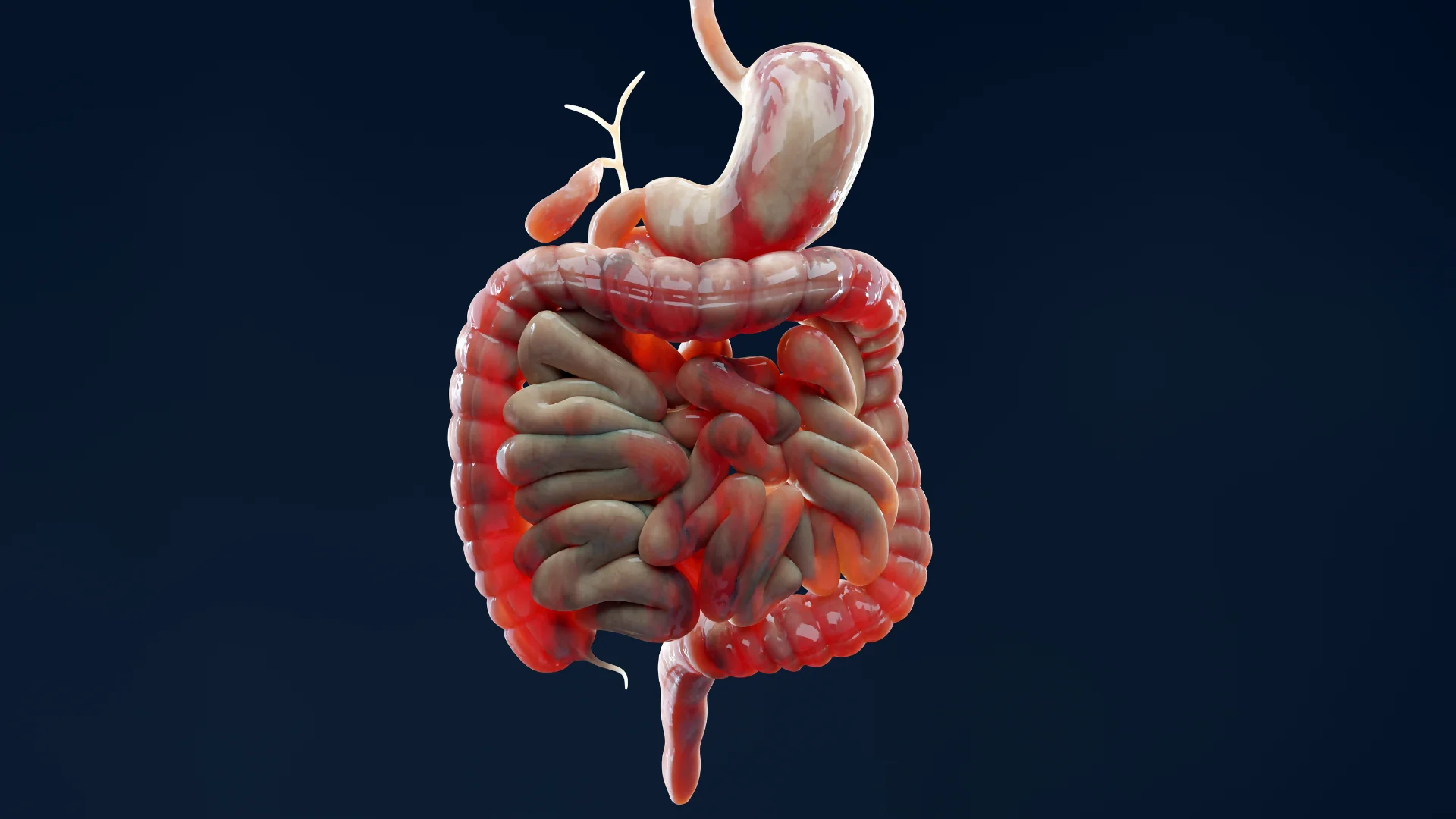 Inflammatory Bowel Disease (IBD) | Causes, Symptoms & Treatment 🔥