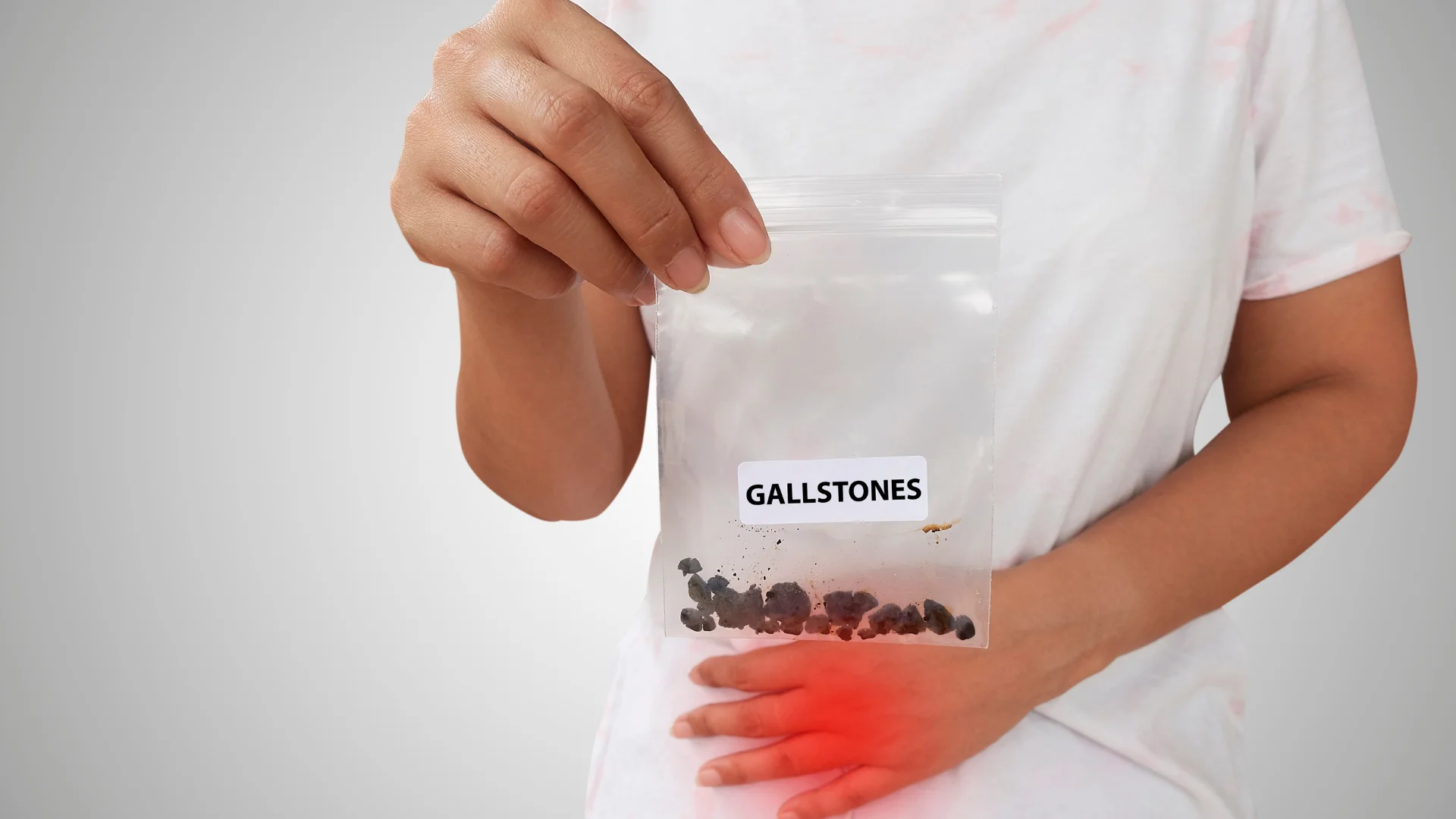 Gallstones | Causes, Symptoms & Treatment Options 🩺